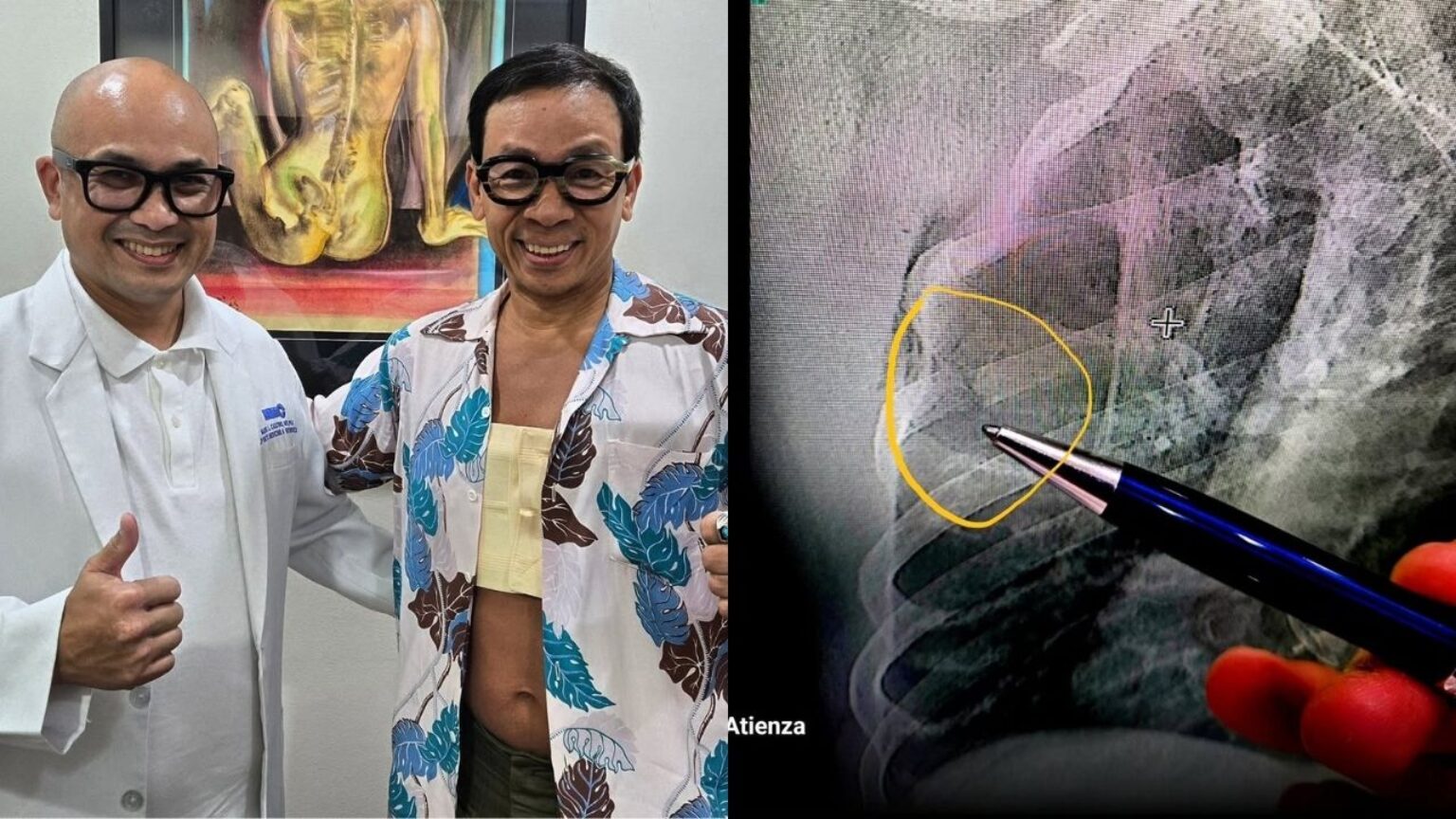 Kuya Kim naaksidente sa motor, nabalian ng buto sa ribs