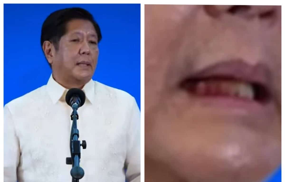 Labi, gilagid ni Pangulong Bongbong nagdugo habang nagtatalumpati?