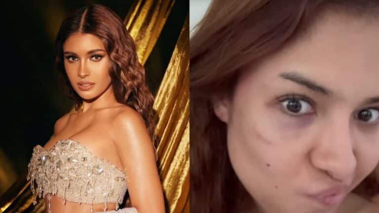 Rabiya nagkapasa sa mukha, basag ang ngipin sa wakeboarding